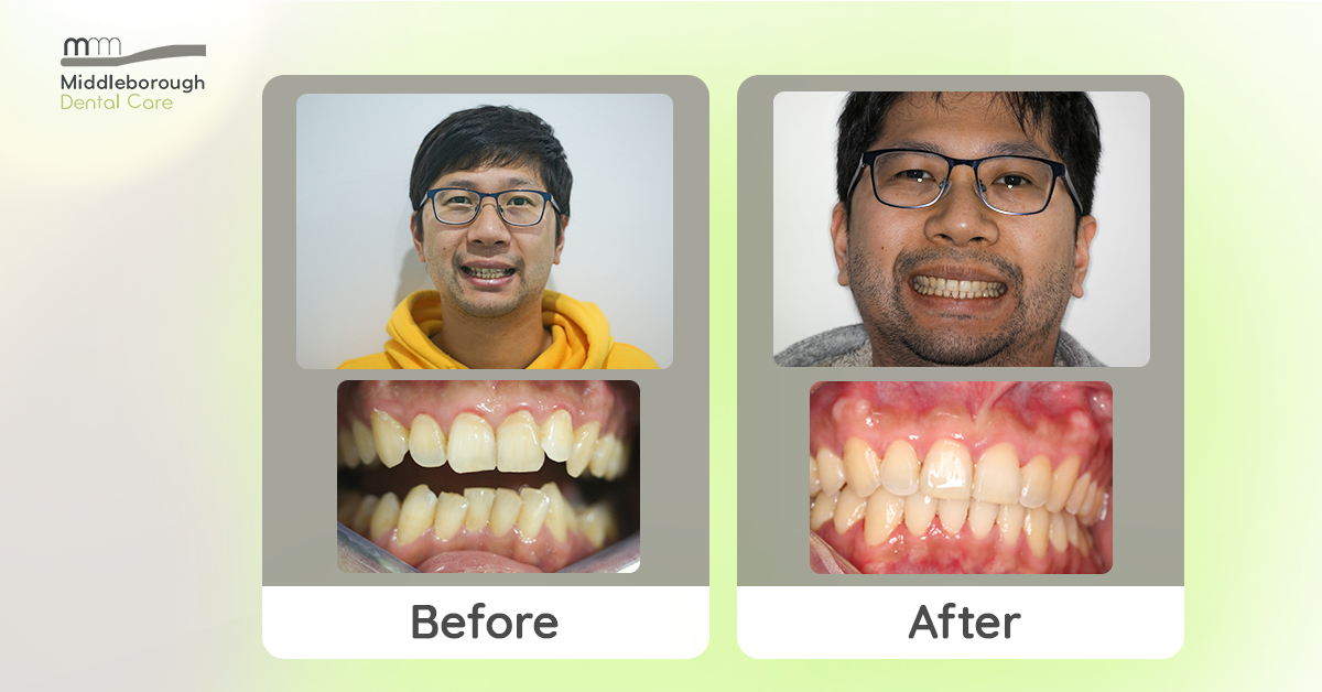 Case study: How orthodontic treatment can put a new smile on your face ...