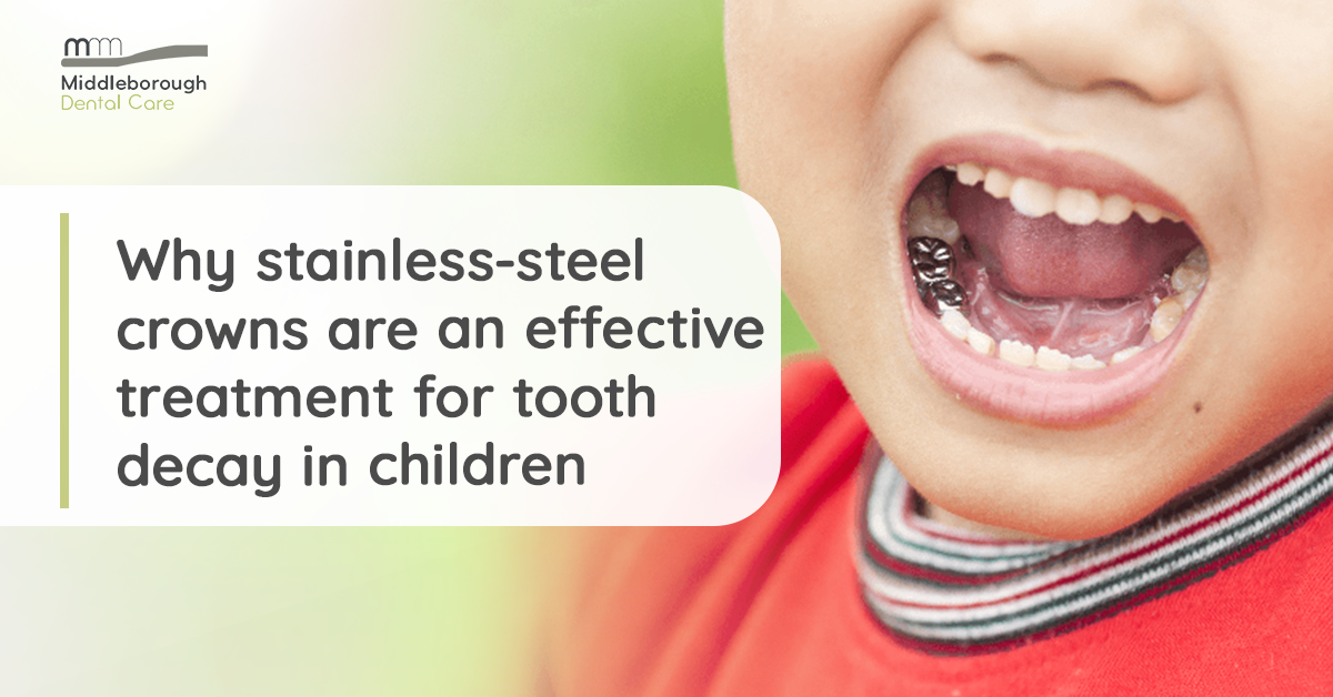 Why stainless-steel crowns are an effective treatment for tooth decay in children ...