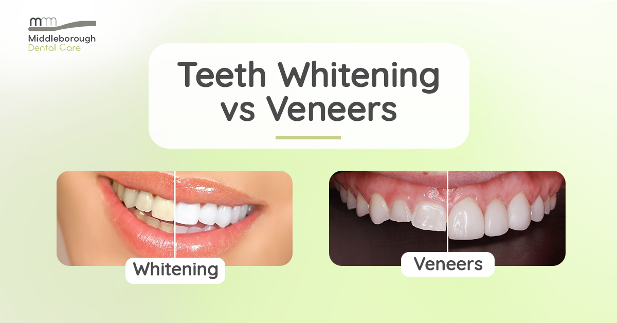 What you should consider when comparing teeth whitening to veneers - Middleborough Dental Care